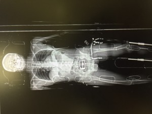 lodox full body AP - Broome Docs